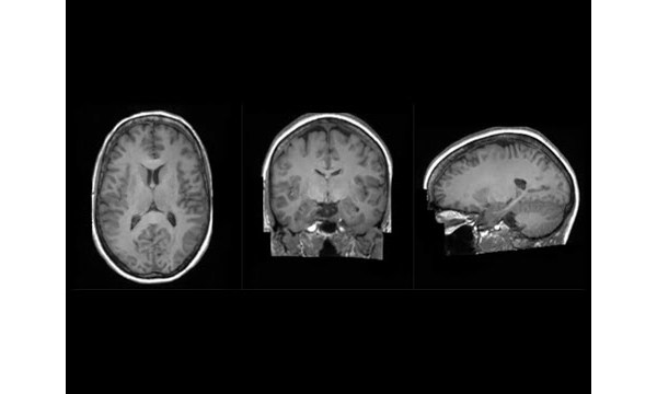 Synthetic Brain Project | King’s College London on NVIDIA Cambridge-1